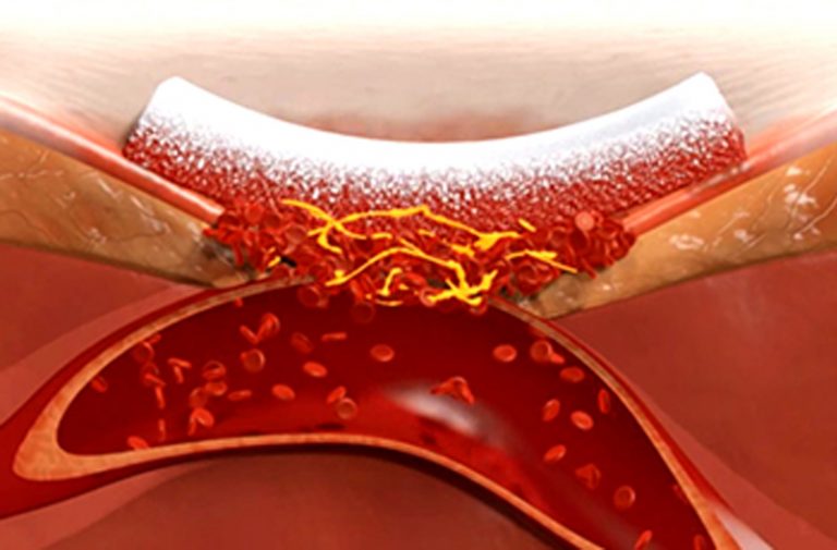 Absortable Hemostatic Sponges - George & Georges MediSurg Limited